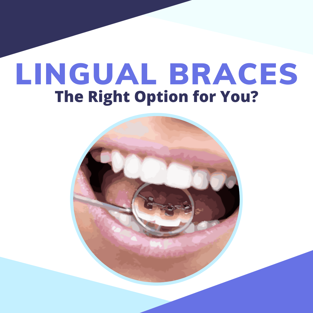 Lingual Braces: The Right Option for Your Teeth? | Smile Prep