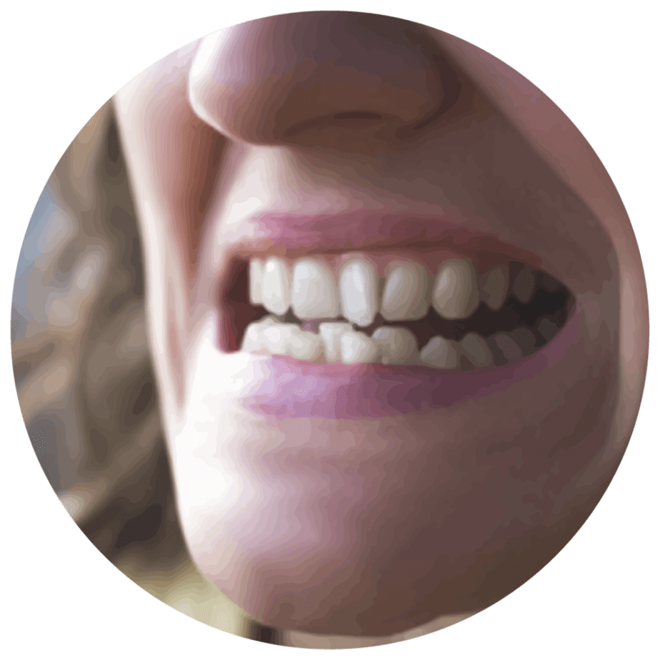 Best Ways to Correct Teeth Crowding in Adults - Smile Prep