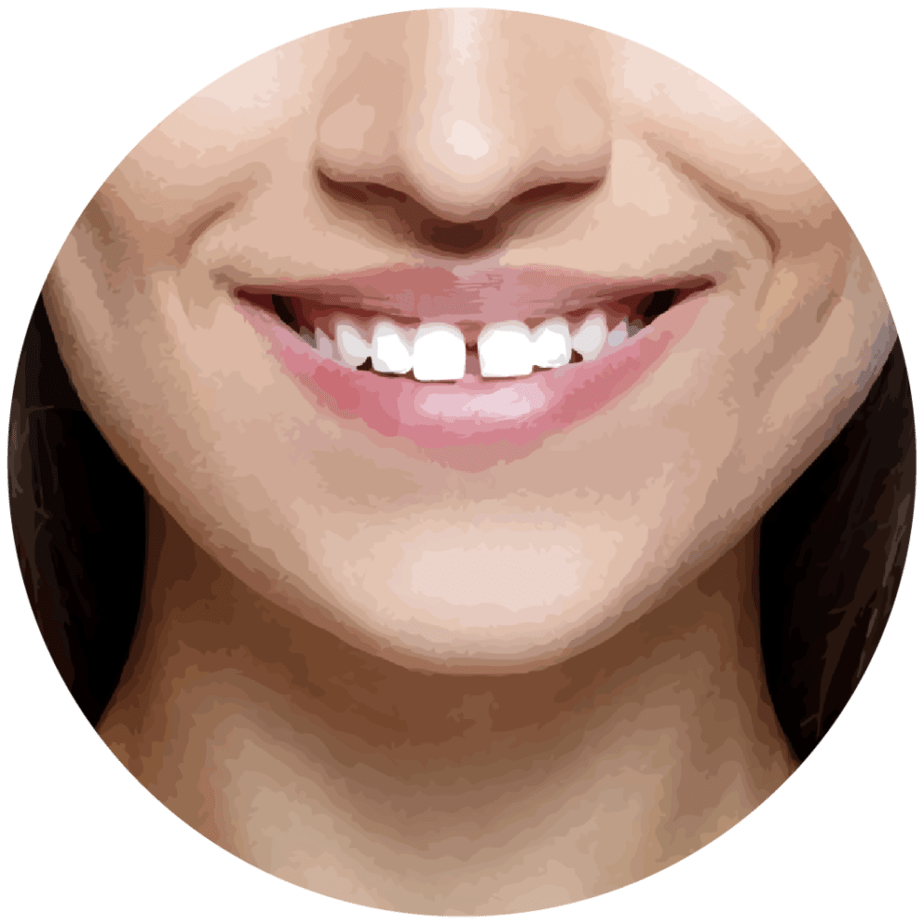 Best Ways to Correct Tooth Gap in Adults - Smile Prep