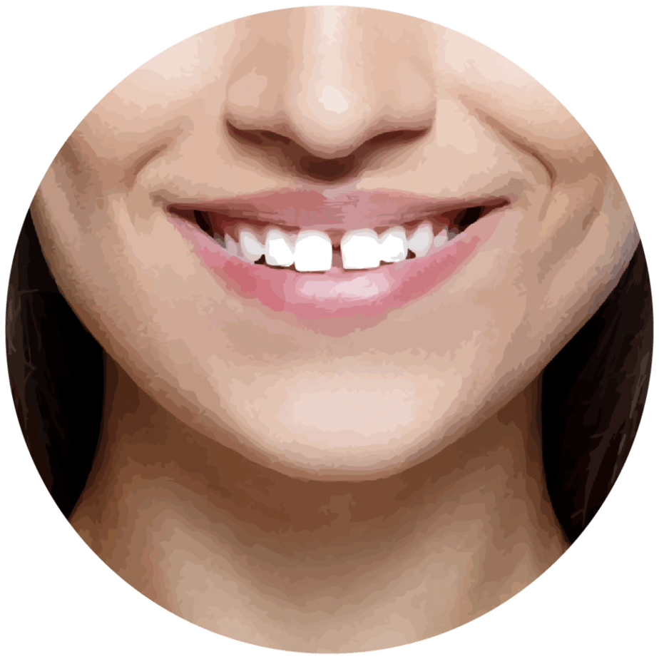 Best Ways to Correct Tooth Gap in Adults - Smile Prep