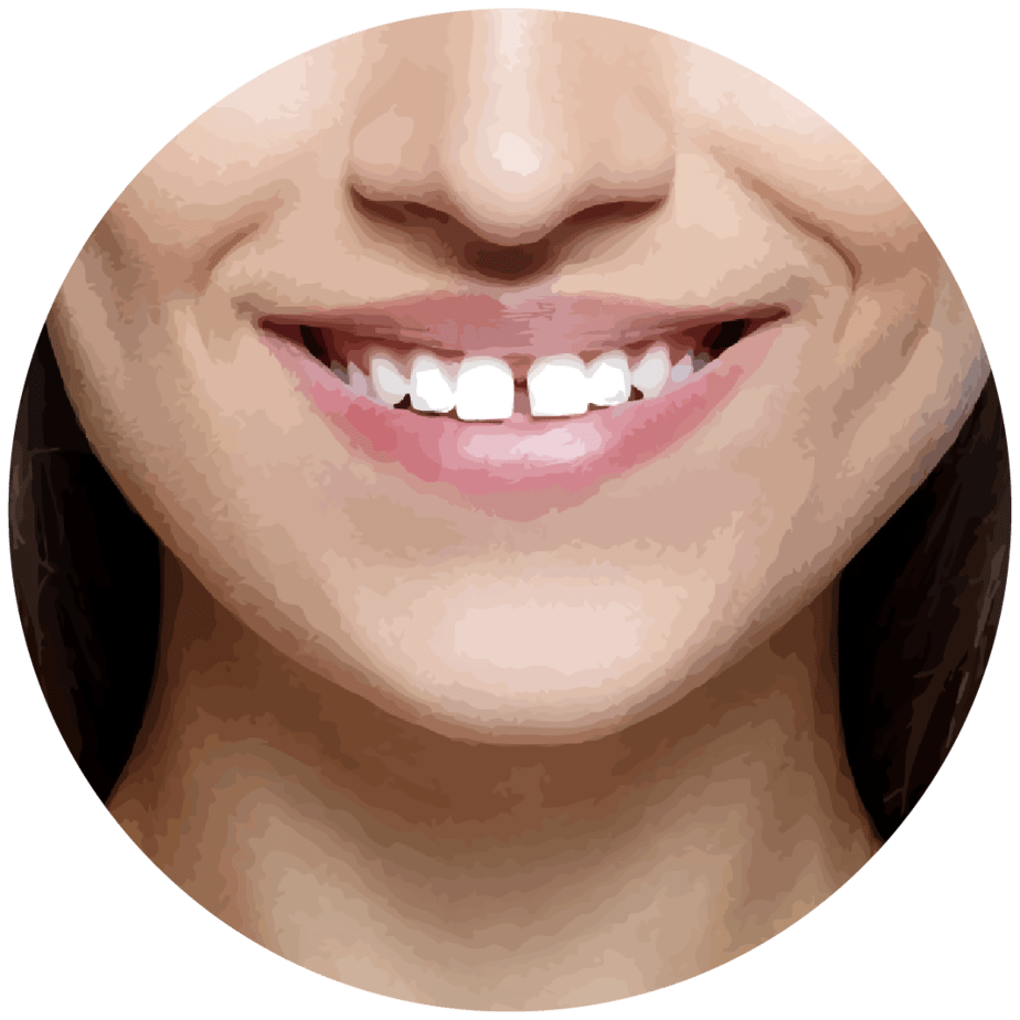 Best Ways to Correct Tooth Gap in Adults - Smile Prep