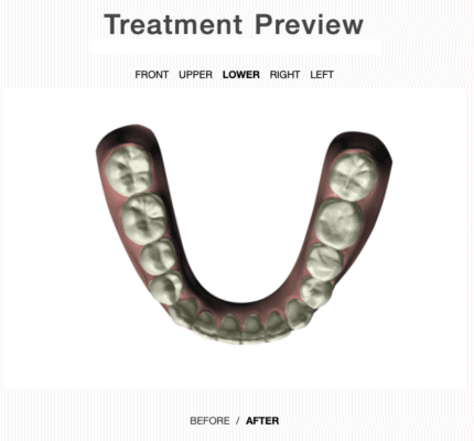 Getting Started With AlignerCo: A Visual Guide | Smile Prep