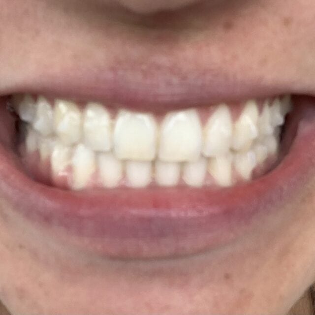 Can Invisalign Correct Crossbite In Adults? - Smile Prep