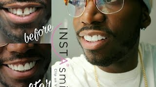 Instasmile Snap-On Veneers: Do They Deliver on Their Promises?